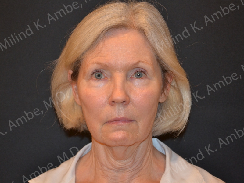 Facelift2 Before & After - Newport Beach Plastic Surgery